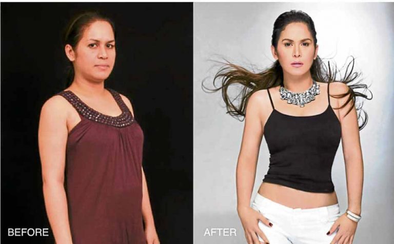 Liposuction, when done right, is a 360-degree experience - MyMedicPlus