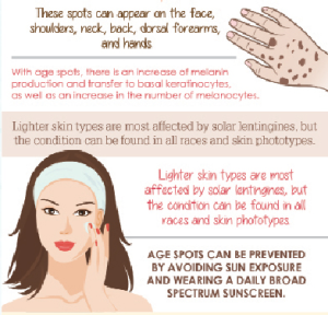 How can I get rid of age spots? - MyMedicPlus