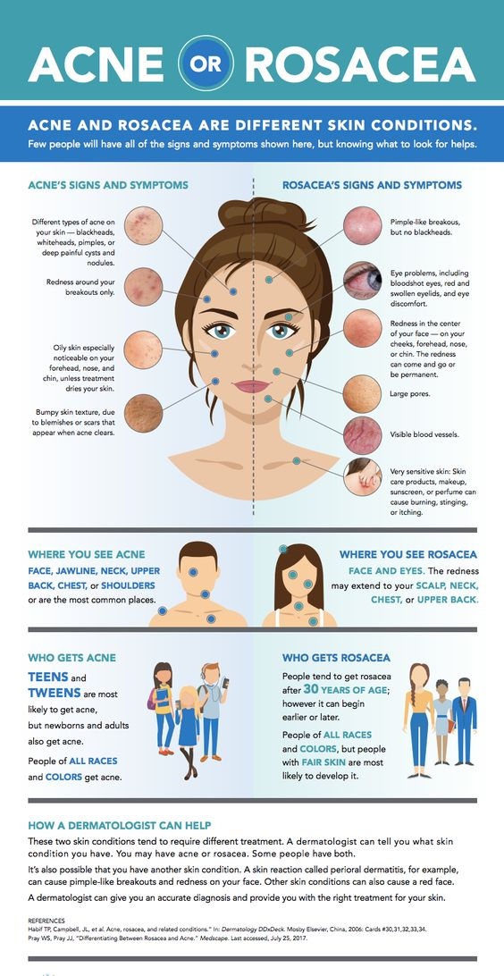 What are some common treatments for rosacea? - MyMedicPlus