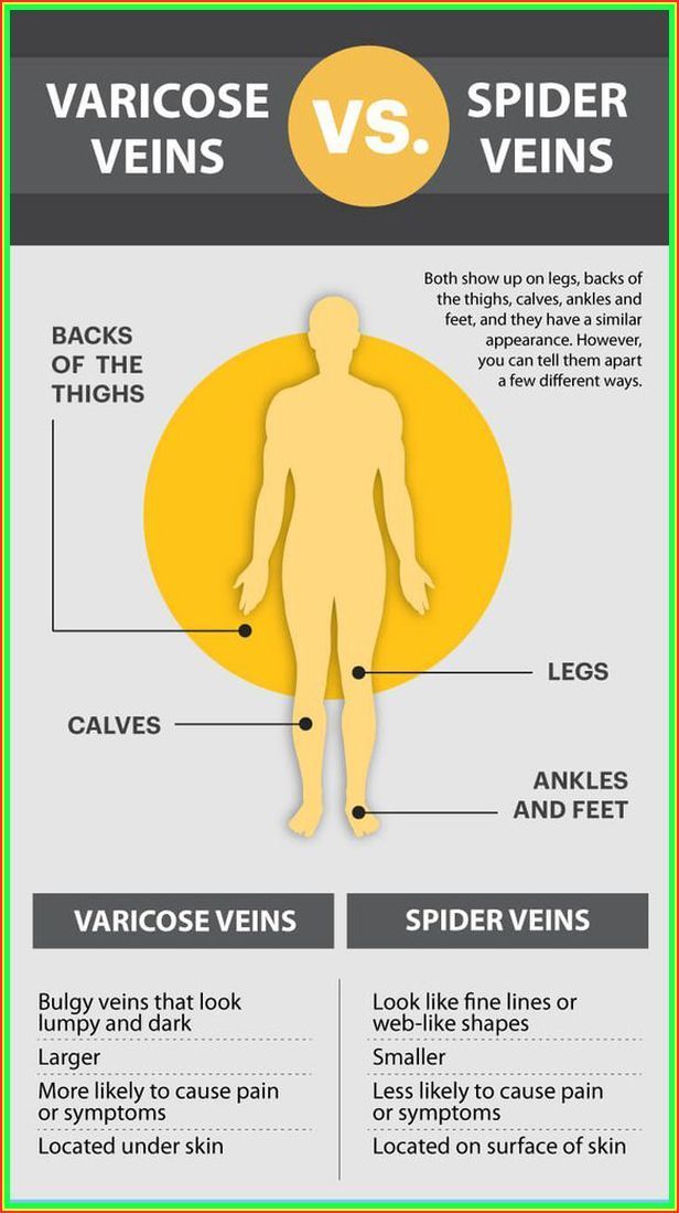 What are some treatments for spider veins? - MyMedicPlus