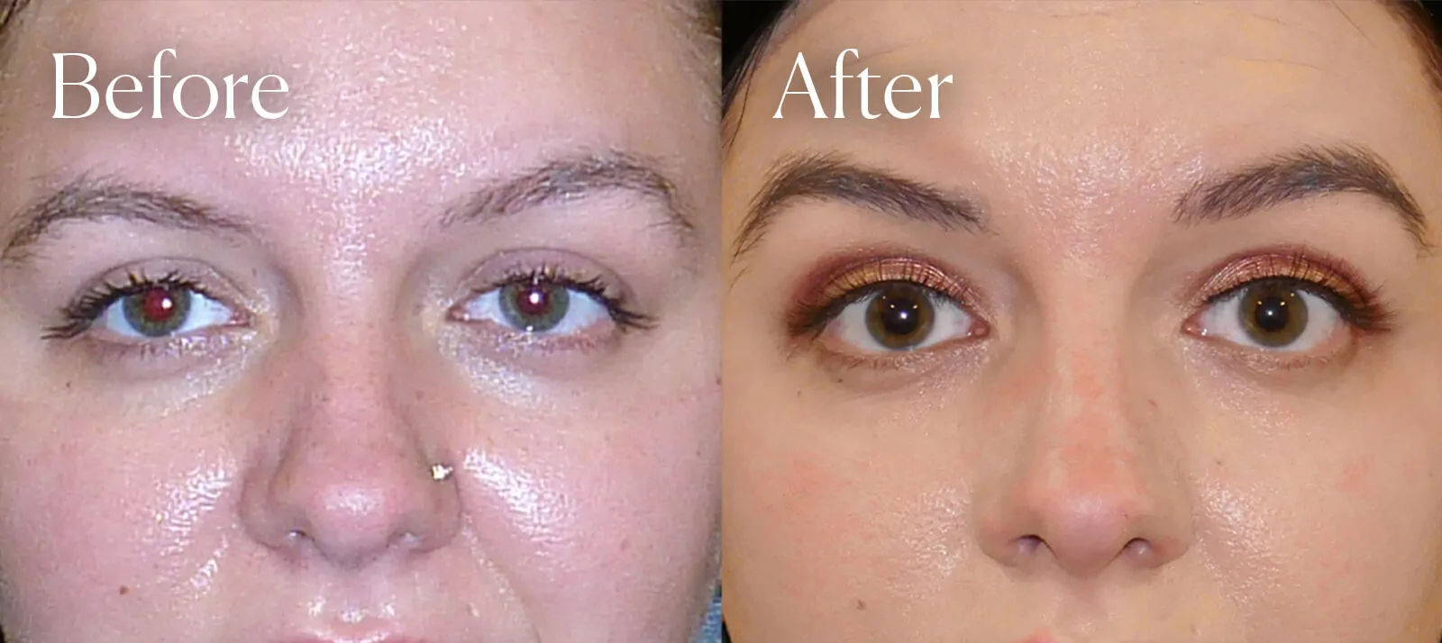 Brow Lift: A Detailed Overview - MyMedicPlus