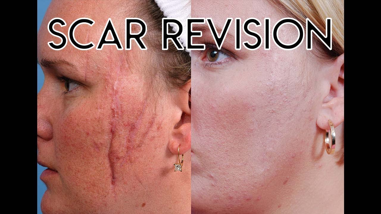 What is Scar revision & how its getting done? - MyMedicPlus