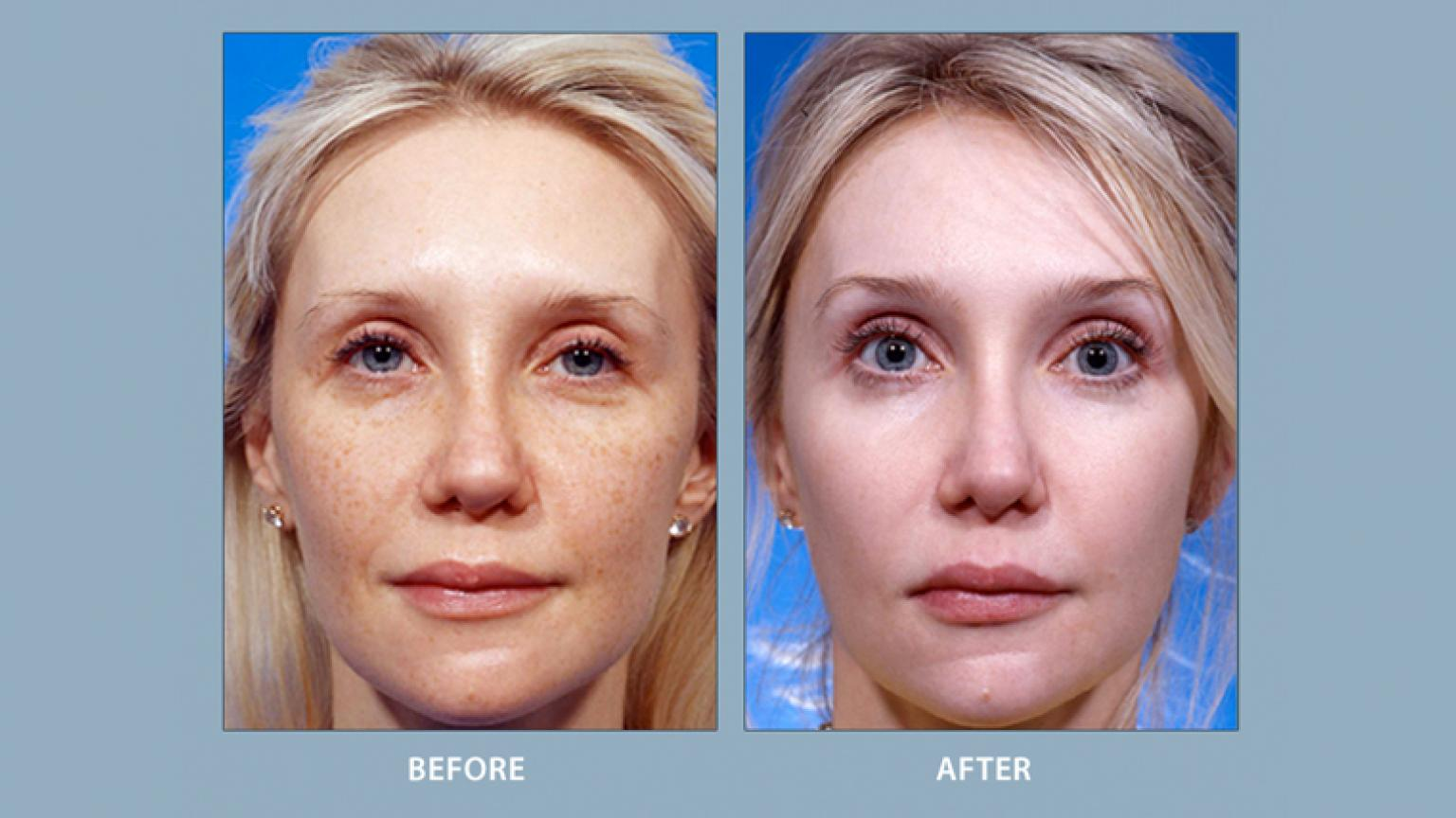 What is Facial implants & how its getting done? - MyMedicPlus